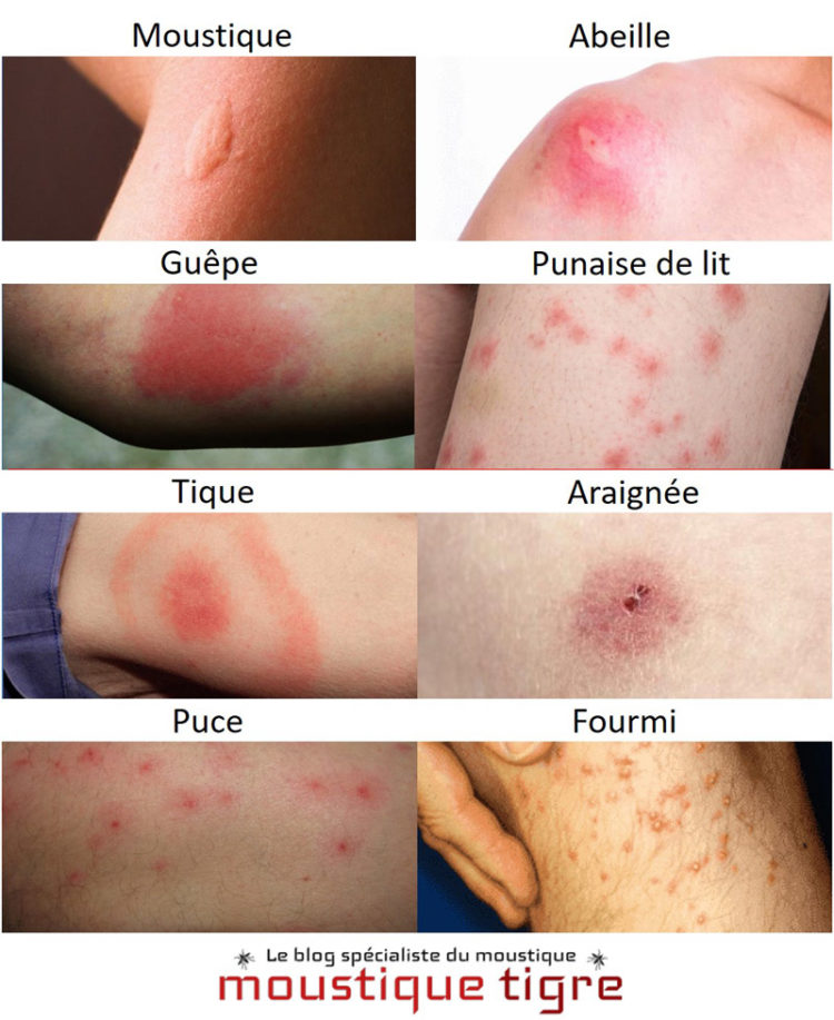 Tout savoir sur la piqure de moustique : exemple, allergie, traitement